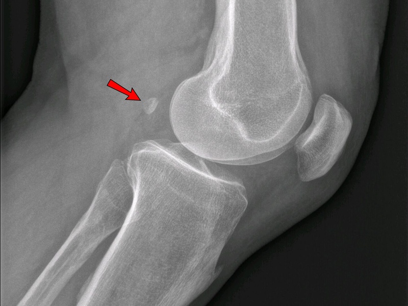 List of Sesamoid Bones - 33Science