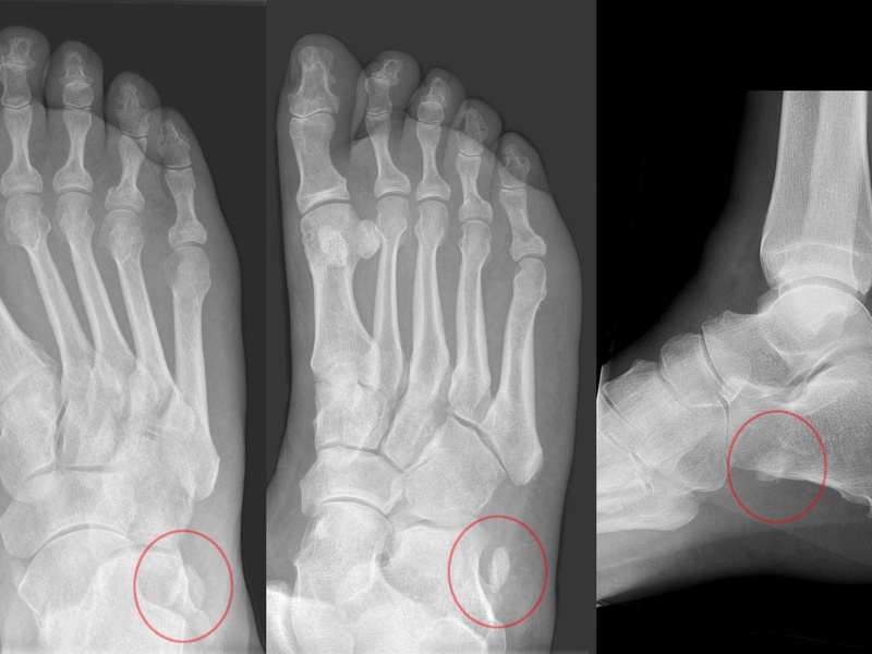 List of Sesamoid Bones - 33Science